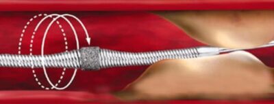 専門診療5 石灰化病変に対する冠動脈カテーテル治療 (Rotablator, Diamondback) – 近畿大学医学部循環器内科学